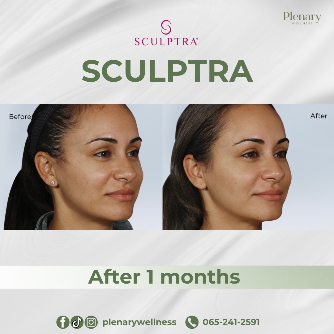 Mesotherapy Sculptra - Plenary Wellness