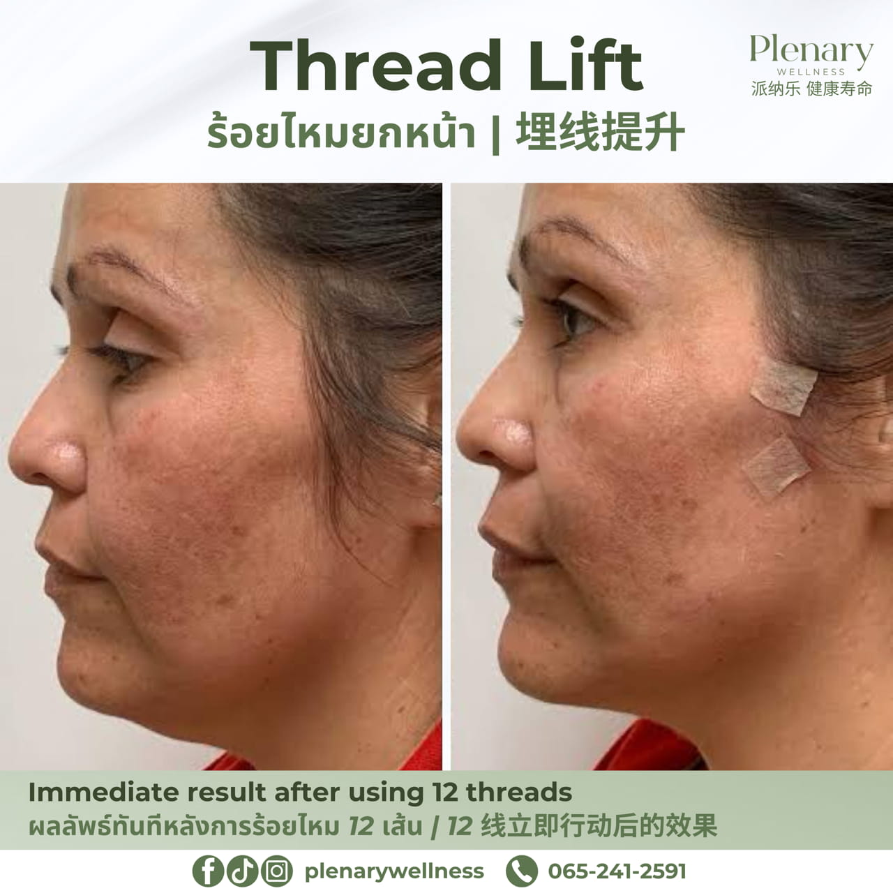 Thread Lift - Plenary Wellness